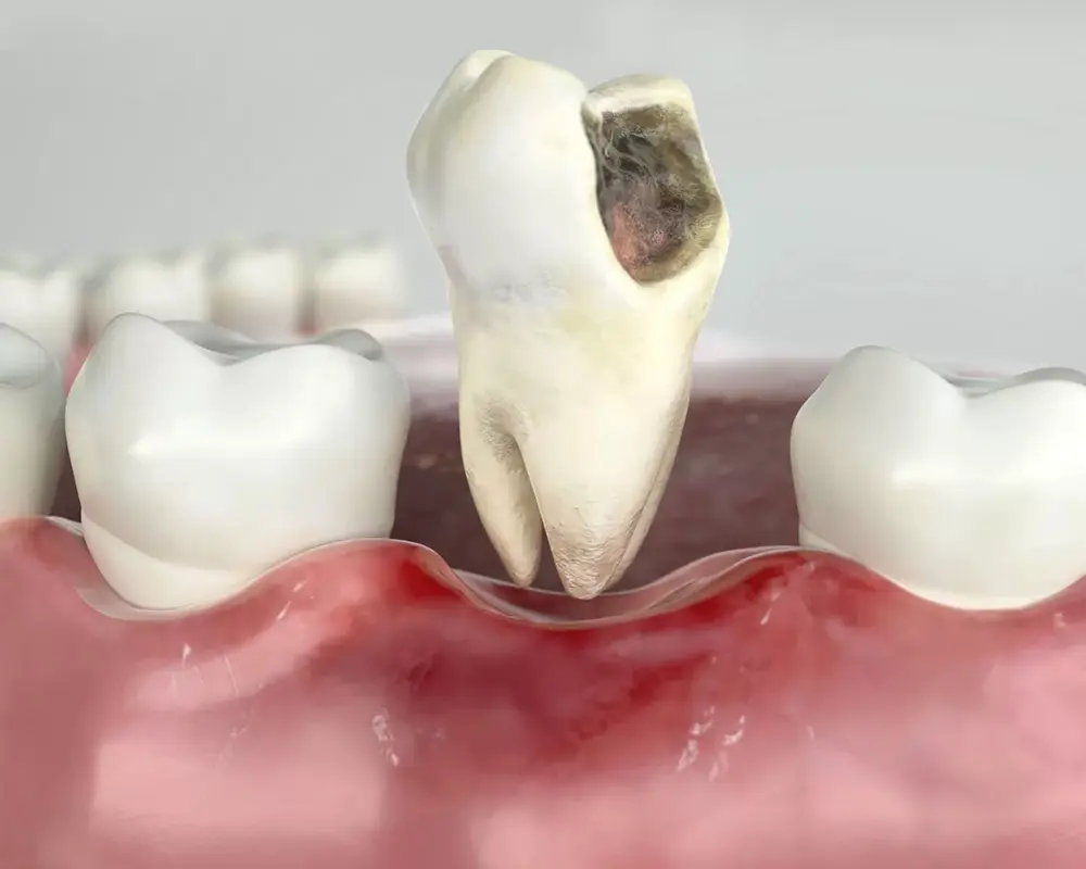 Post-Procedure Information | Charlotte, NC | Urban Family Dental